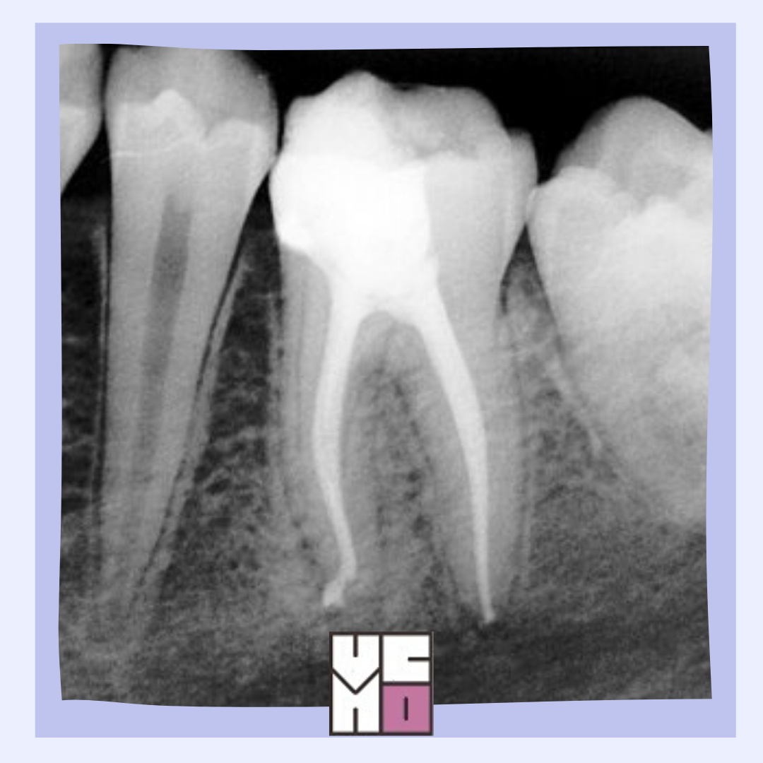 Luego de un tratamiento de conducto - ARTÍCULOS DE INTERÉS: NUESTRO ...